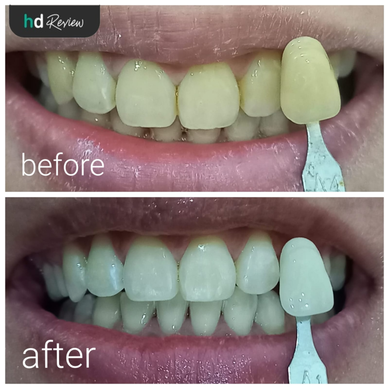 Review: Bleaching Gigi Bonus Scalling di M&W Family Dental | HDmall