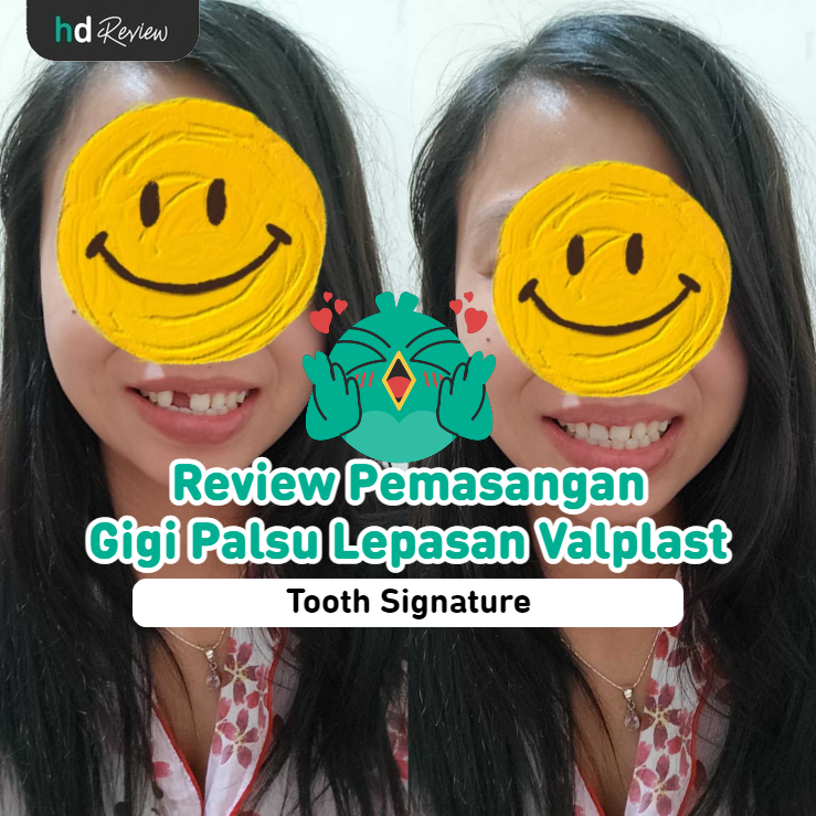 Review Pemasangan Gigi Palsu Lepasan Valplast di Klinik Tooth Signature ...